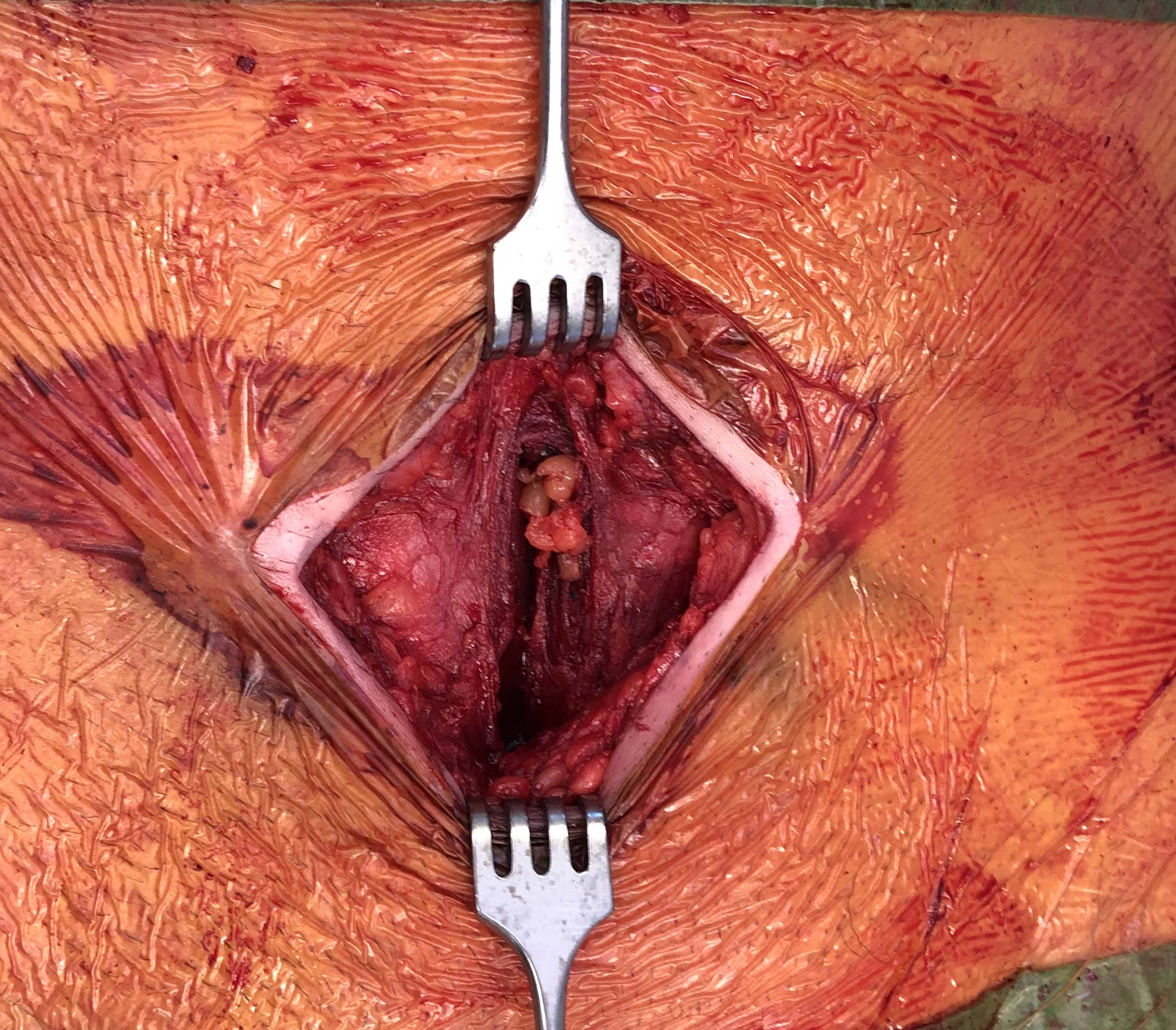 AP Compression | The Bone School